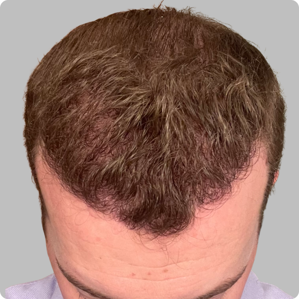 Roots By Genetic Arts - Hair Loss DNA Test and Customized Topical - Roots