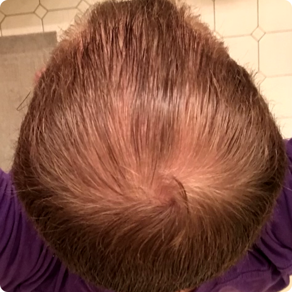 Roots By Genetic Arts - Hair Loss DNA Test and Customized Topical - Roots