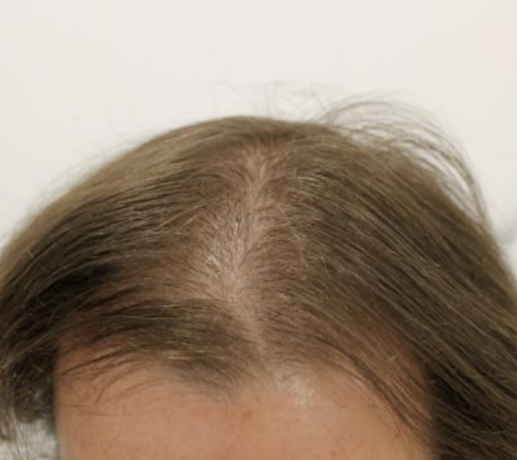 Roots By Genetic Arts - Hair Loss DNA Test and Customized Topical - Roots