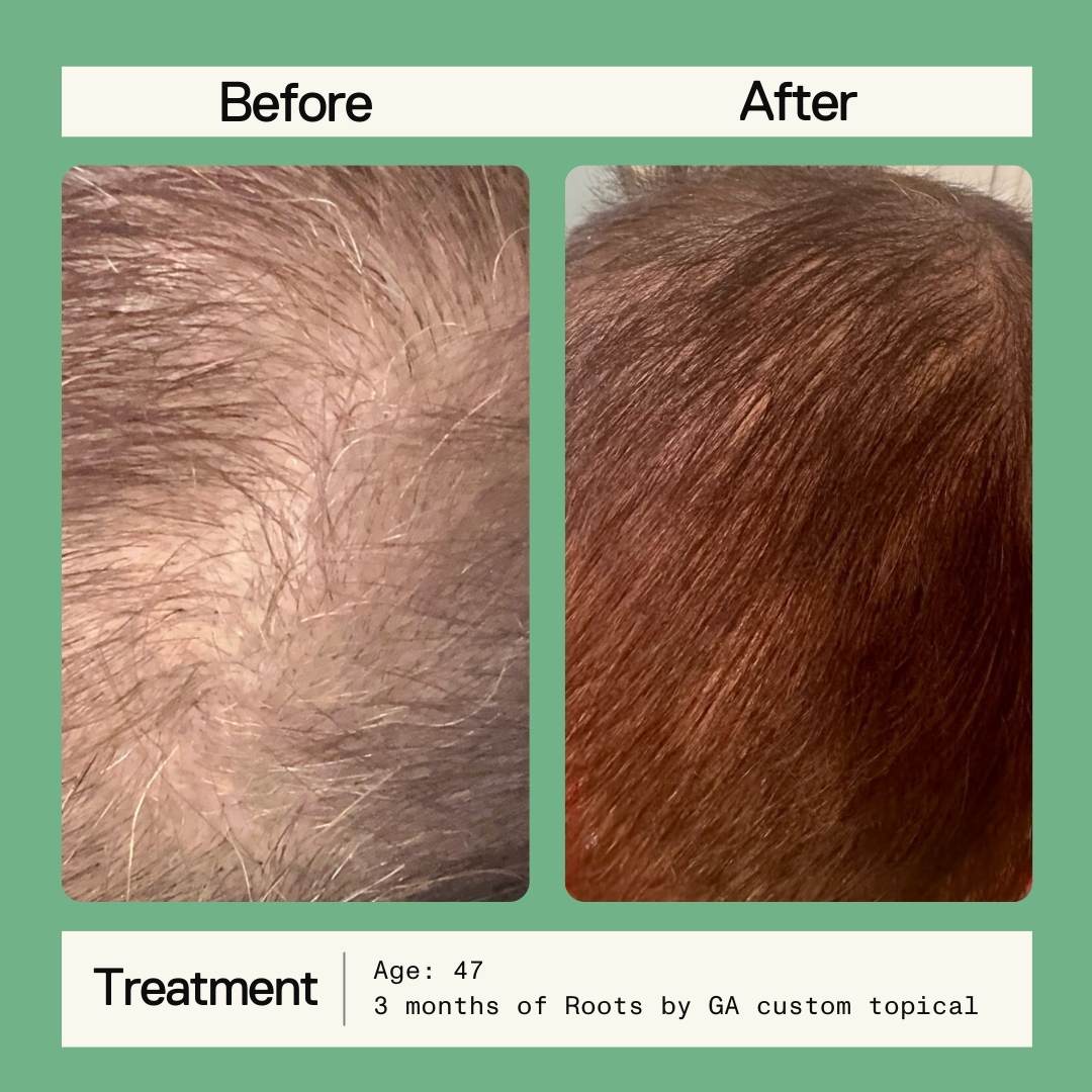 Personalized hair growth topical (60ml) - Roots