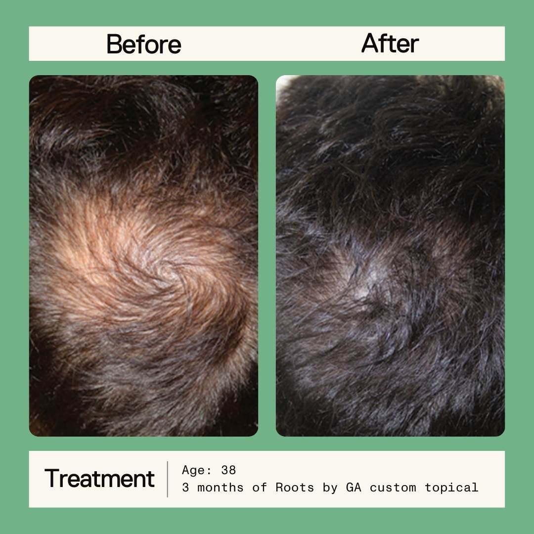 Personalized hair growth topical (60ml) - Roots